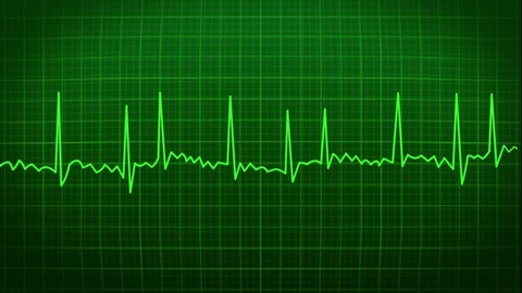 Ecg Heartbeat Heart Fibrillation Atrial Medical Stock Footage Video ...