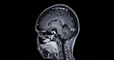 Mri Brain Sagittal T1 Fs Gadolinium Stock Footage Video (100% Royalty ...