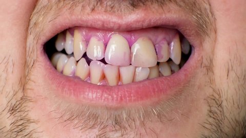 Plaque On Human Teeth Colored Pink Stock Footage Video (100% Royalty ...