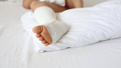 Childrens Leg Orthopedic Cast On White Stock Footage Video (100% ...