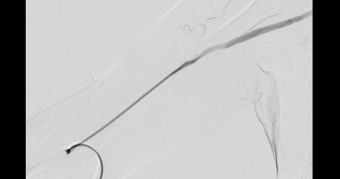 Angiogram Balloon Dialysis Catheter Inflated Arteriovenous Stock ...