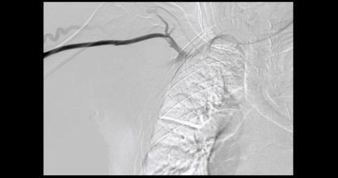 Angiogram Balloon Dialysis Catheter Inflated Arteriovenous Stock ...