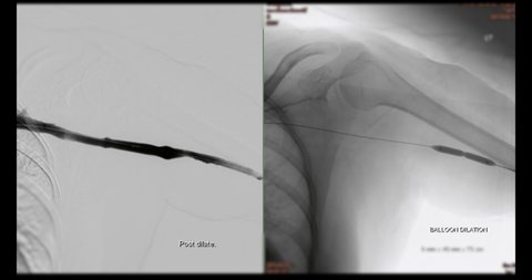 Angiogram Balloon Dialysis Catheter Inflated Arteriovenous Stock ...