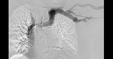 Angiogram Balloon Dialysis Catheter Inflated Arteriovenous Stock ...