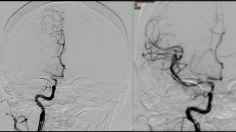 Cerebral Angiography Fluoroscopy Intervention Radiology Showing Stock ...