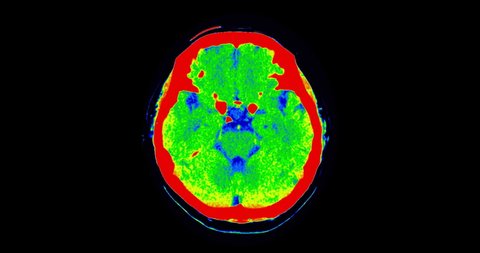 Ct Scan Brain Colorful Mode Pet Stock Footage Video (100% Royalty-free ...