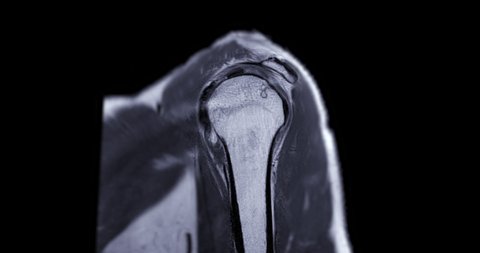 Magnetic Resonance Imaging Mri Shoulder Joint Stock Footage Video (100% Royalty-free) 1095031457 ...