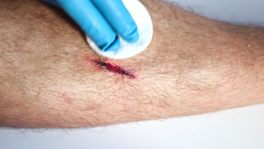 Wound Stock Video Footage | Royalty Free Wound Videos | Pond5