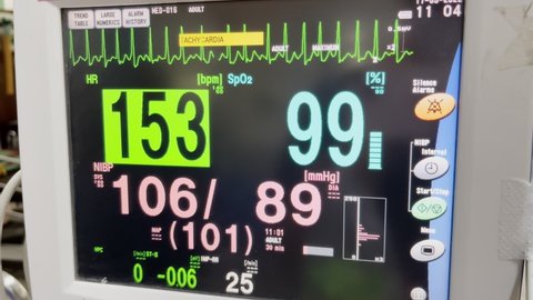 Patient Monitor Shows Patients Heart Rate Stock Footage Video (100% ...