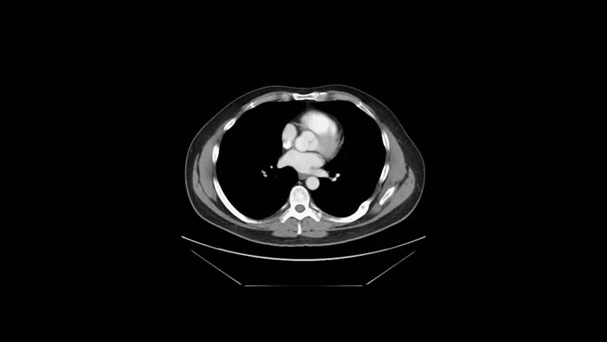 CT-SCAN-CHEST Footage, Videos and Clips in HD and 4K - Avopix.com