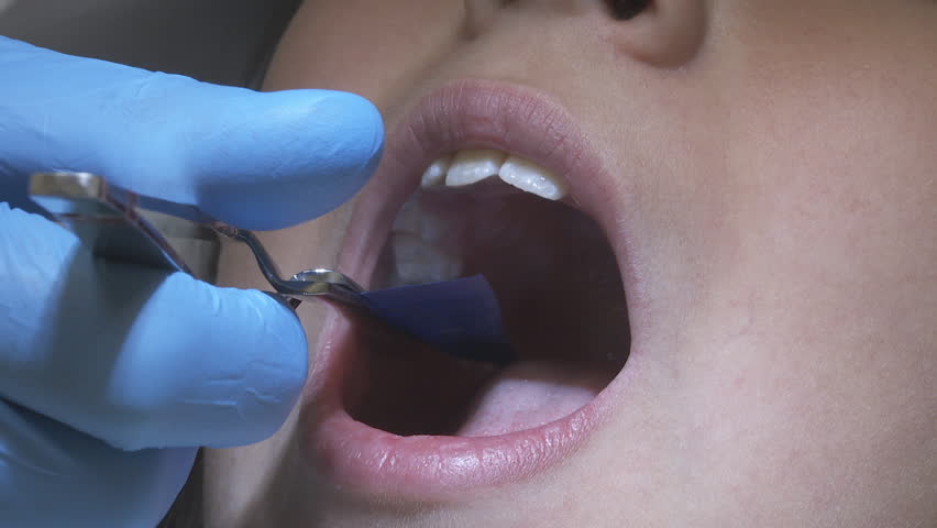 Dentist Bite Test On Young Stock Footage Video (100% Royalty-free ...