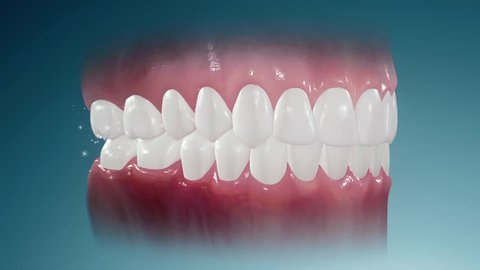 Proffesioinal Teeth Whitening Lightactivation On Tooth Stock Footage ...