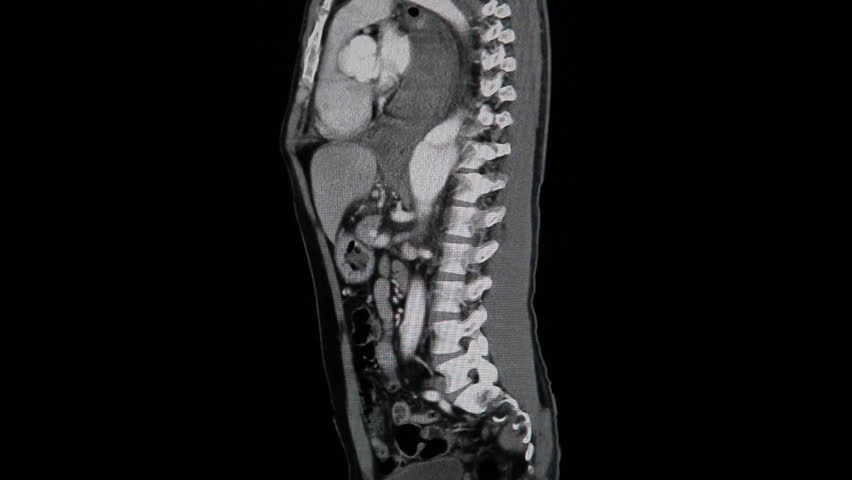 cta abdominal aorta sagittal mip view Stock Footage Video (100% Royalty ...
