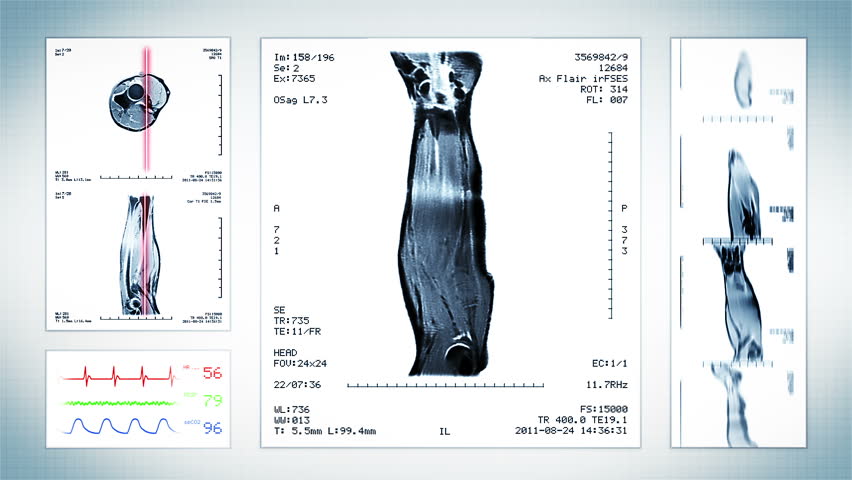 arm mri scan white 3 videos Stock Footage Video (100% Royalty-free ...