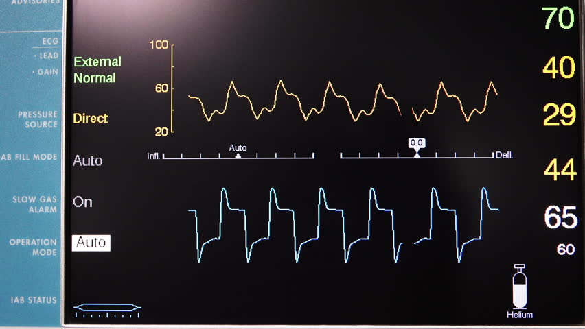 「Intra Aortic Balloon Pump Screen」の動画素材（ロイヤリティフリー）14891740 | Shutterstock