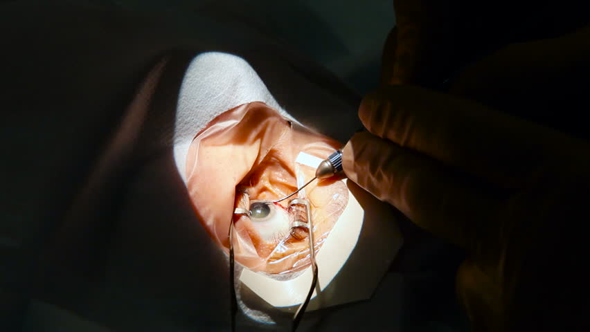 Ophthalmology. Eye Surgery. Doctor Injects Stock Footage Video (100% ...
