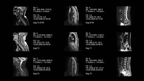 4k Set Spine Mri Real Animated 스톡 동영상 비디오(100% 로열티 프리) 17039713 ...