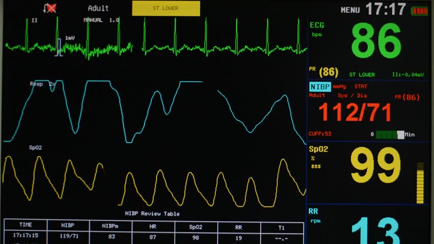 ekg monitor Stock Footage Video (100% Royalty-free) 17082634 | Shutterstock