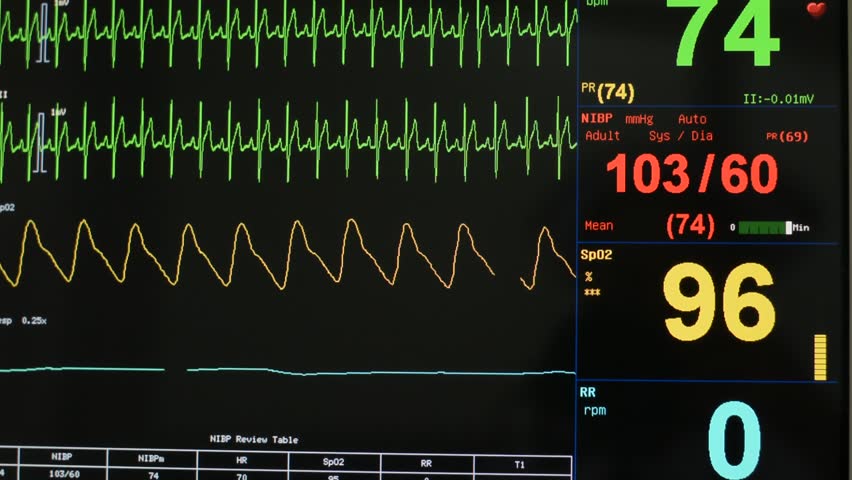 Ekg Monitor in Icu Unit Stock Footage Video (100% Royalty-free ...