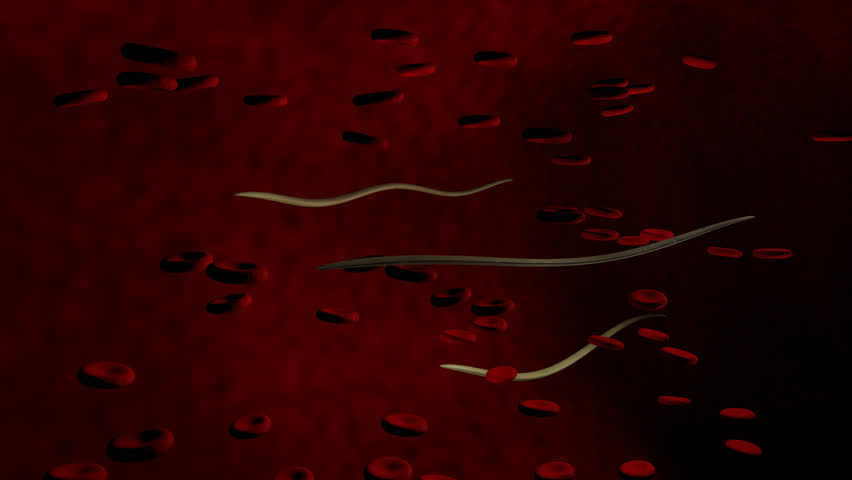 Parasitic Nematode Disease. Filariasis Worm Stock Footage Video (100% Royalty-free) 17409526 ...