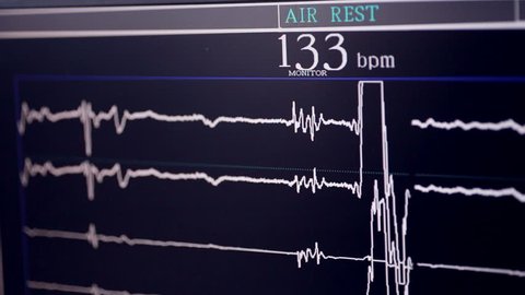 Real Cardiogram Working Cardiograph Cardiology Hospital Stock Footage ...