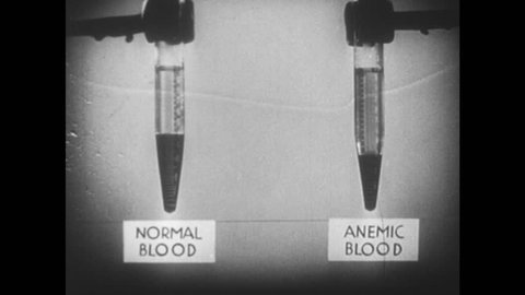 Usa 1950s Two Vials Blood Activity Stock Footage Video (100% Royalty ...