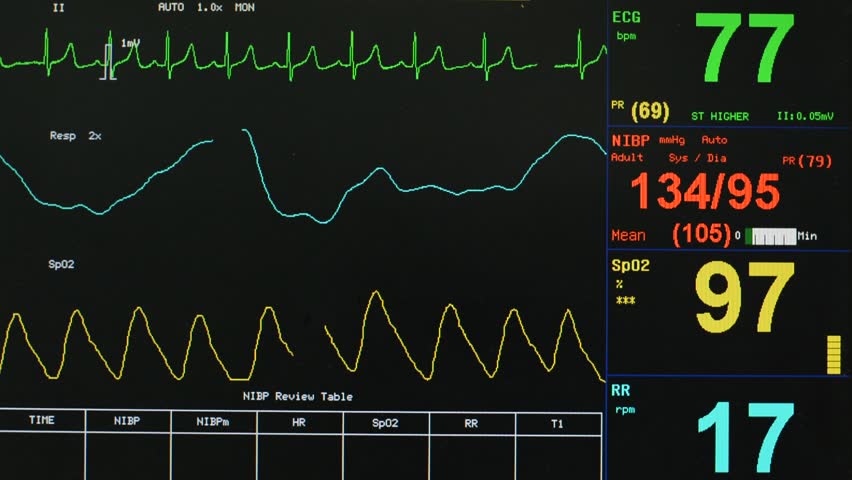 icu screen monitoring dying patient vital Stock Footage Video (100% ...