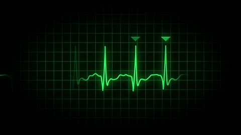 Animated Ekg Heart Monitor Display Stock Footage Video (100% Royalty ...
