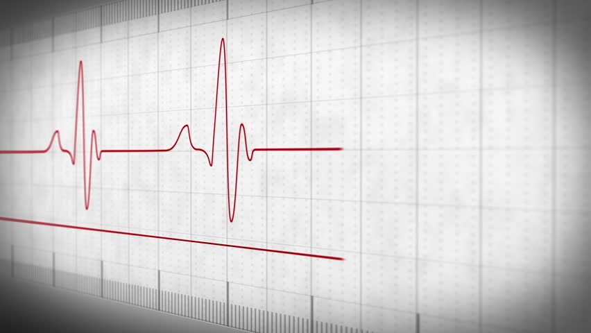 ekg electrocardiogram pulse real waveform on Stock Footage Video (100% ...