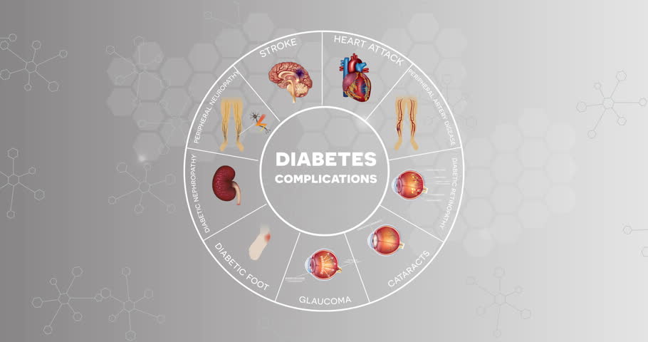 Diabetes Mellitus Affected Organs Info Stock Footage Video (100% ... Diabetes Mellitus Affected Organs Info Stock Footage Video (100% ...