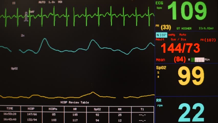Ekg Monitor in Icu Unit Stock Footage Video (100% Royalty-free ...