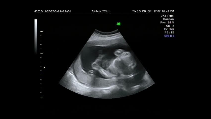 Echograph Stock Video Footage - 4K and HD Video Clips | Shutterstock