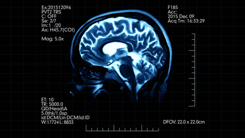 Mri Brain Scan Profile Animation Stock Footage Video (100% Royalty-free ...