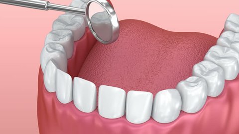 Oral Hygiene Scaling Root Planing Conventional Stock Illustration ...