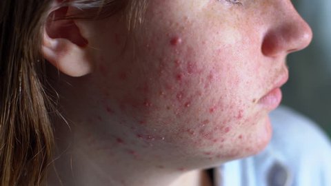 Face Acne Problem Closeup Stock Footage Video (100% Royalty-free ...