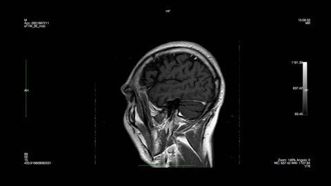 Head Mrt Scan Stock Footage Video (100% Royalty-free) 3456638 ...