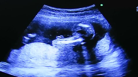Its A Boy Ultrasound 20 Weeks