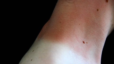 Staphylococcal Streptococcal Skin Infection Bullous Impetigo Stock ...