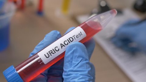 Scientist Holding Uric Acid Test Tube Stock Footage Video (100% Royalty ...