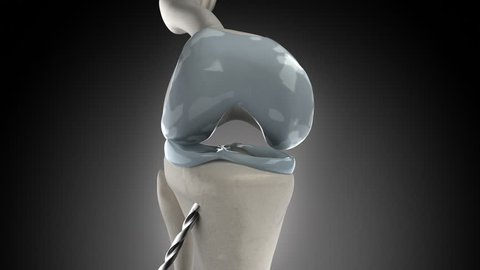 Knee Arthroscopic Cruciate Ligament Replacement Stage Stock Footage ...