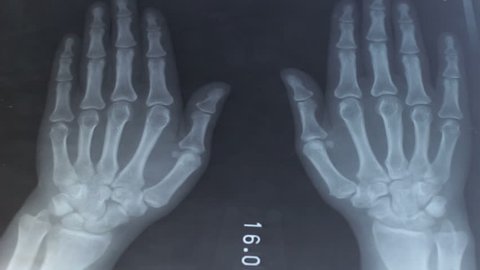 Film Xray Both Hand Ap Show Stock Photo 189882752 | Shutterstock
