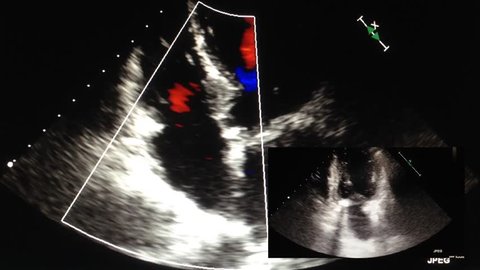 Echocardiography Ultrasound Examination Heart Stock Footage Video (100% ...