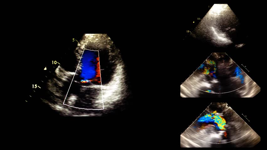 echocardiography ultrasound examination heart Stock Footage Video (100% ...