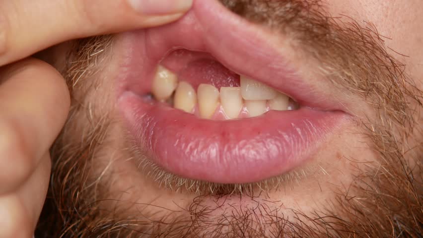 toothless man laughs bearded without teeth Stock Footage Video (100% ...