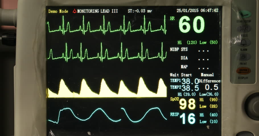 Ecg Monitor Patients Condition in 스톡 동영상 비디오(100% 로열티 프리) 34402219 ...