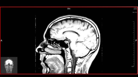 Head Mrt Scan Stock Footage Video (100% Royalty-free) 3456638 ...