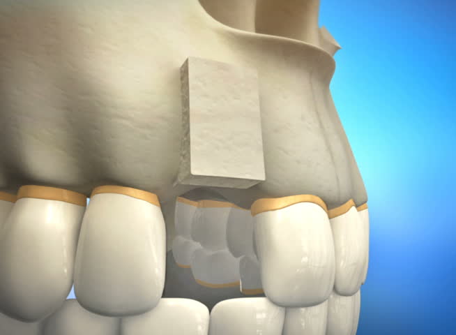 Dental Surgery Animation of Teeth Stock Footage Video (100% Royalty ...