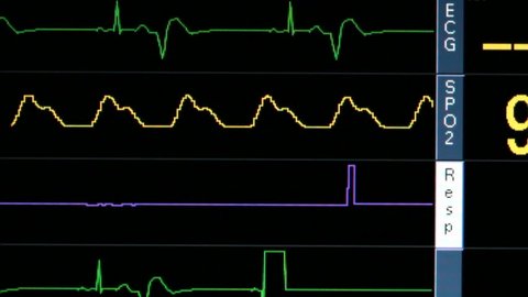 Screen Electrocardiogram Ecg Ekg Device Fake Stock Footage Video (100% ...
