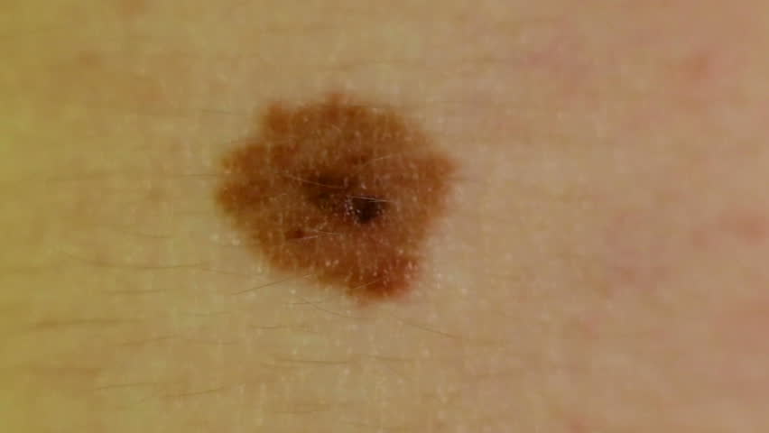 human skin mole extreme close-up shoot Stock Footage Video (100% ...