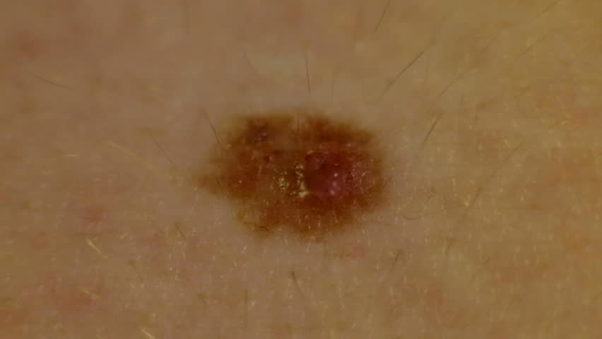 human skin mole extreme close-up shoot Stock Footage Video (100% ...